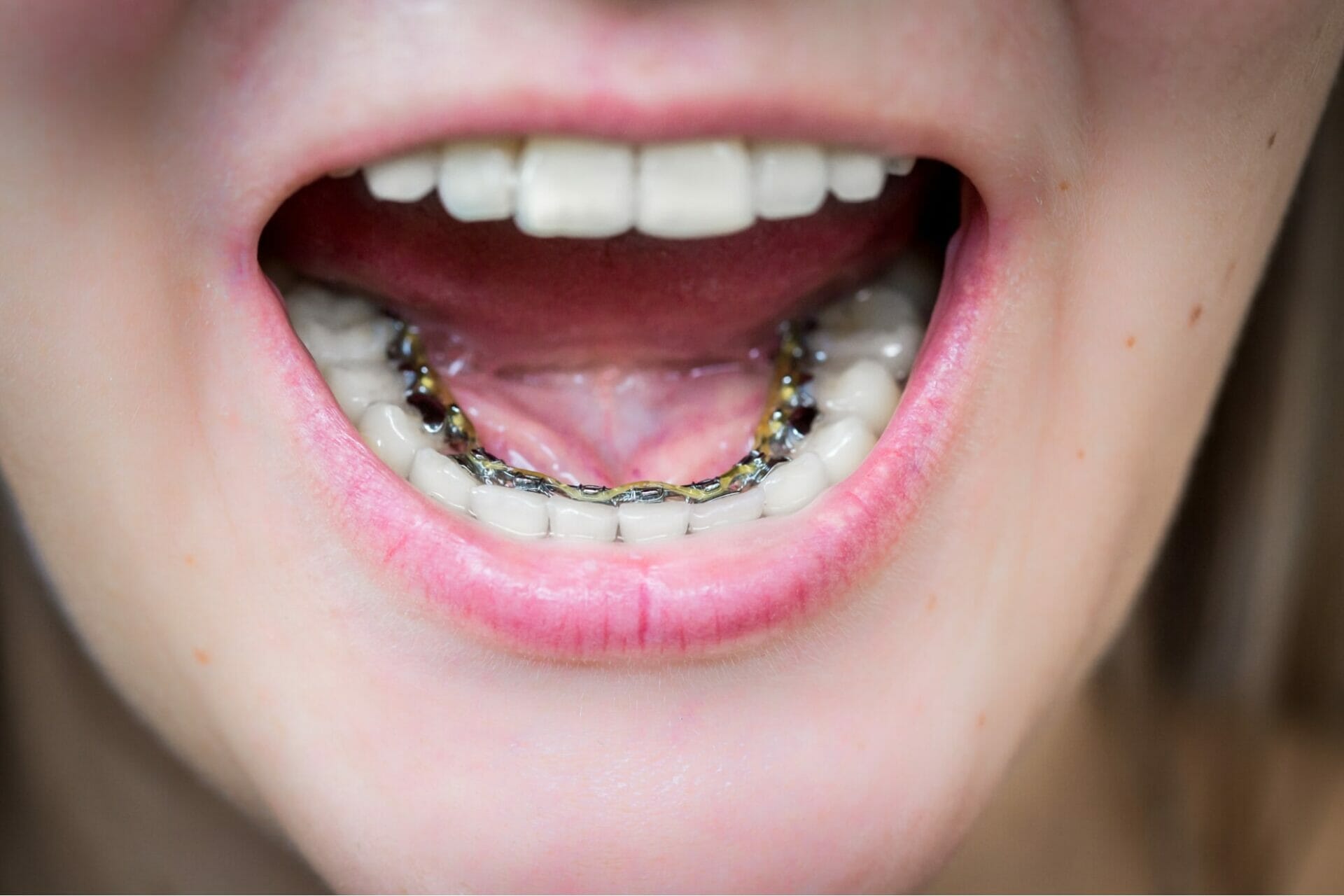 Why Orthodontic Treatment is Never Too Late for Adults | Bellevue Hill ...
