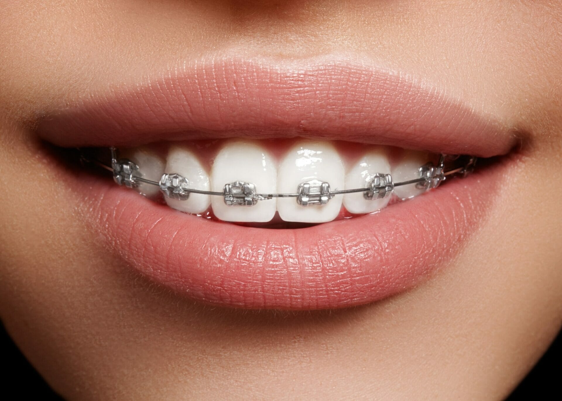 Why Orthodontic Treatment is Never Too Late for Adults | Bellevue Hill ...